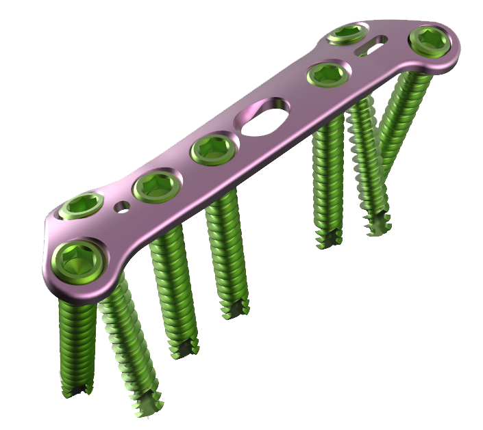 MetaFuse MTP Plate | HNM Medical